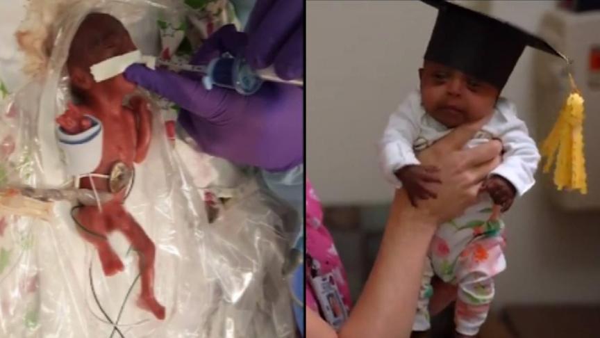 Saybie, la bebé más pequeña del mundo, sobrevive y es dada de alta