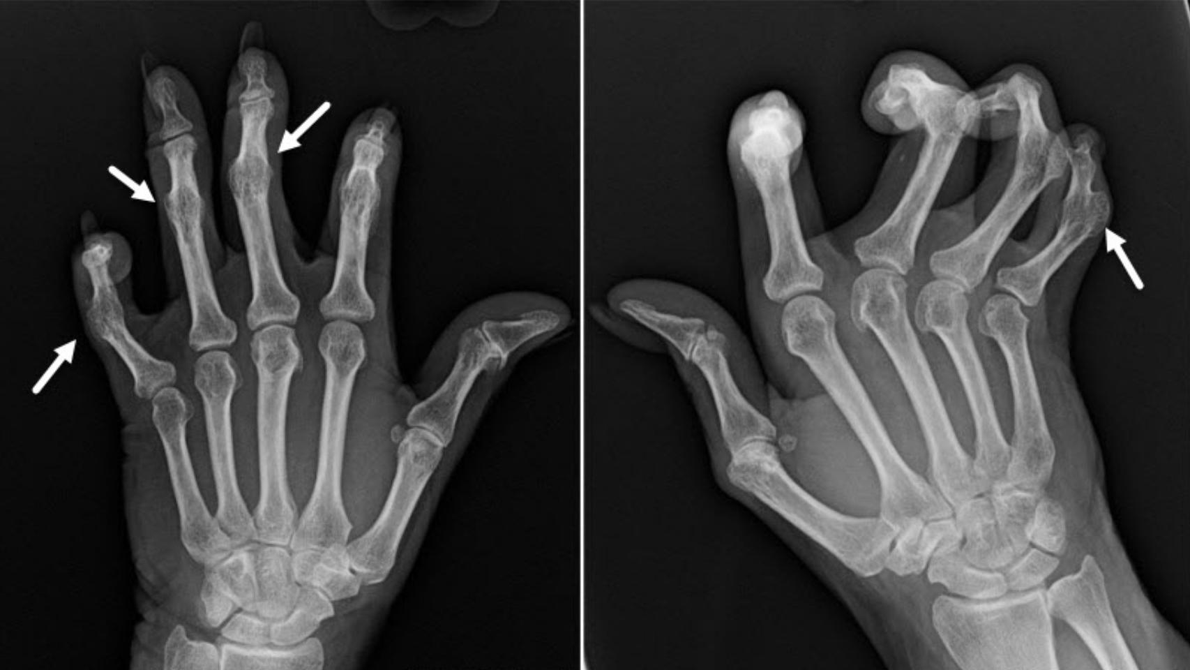 Rayos X De La Osteoartritis Rayos X De La Osteoartritis