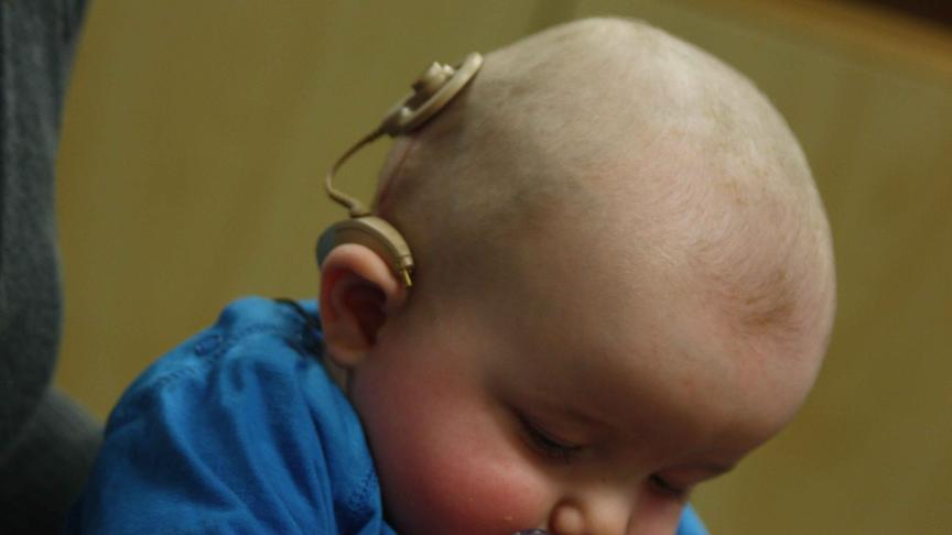 Tecnología para recuperar el oído: así funcionan los implantes cocleares