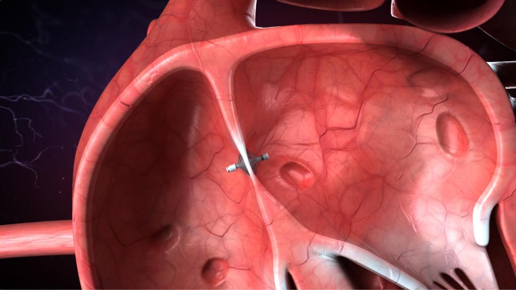 El sensor que vigila el corazón y avisa al médico si algo va mal ya se ...