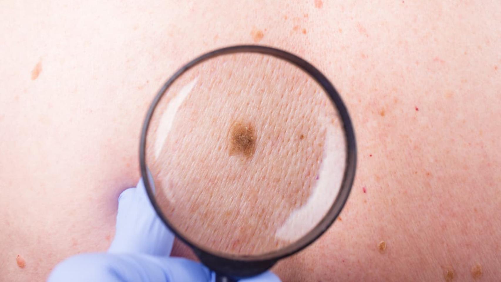 Golpe al melanoma: ésta es la nueva técnica que logra frenar el cáncer de piel más letal