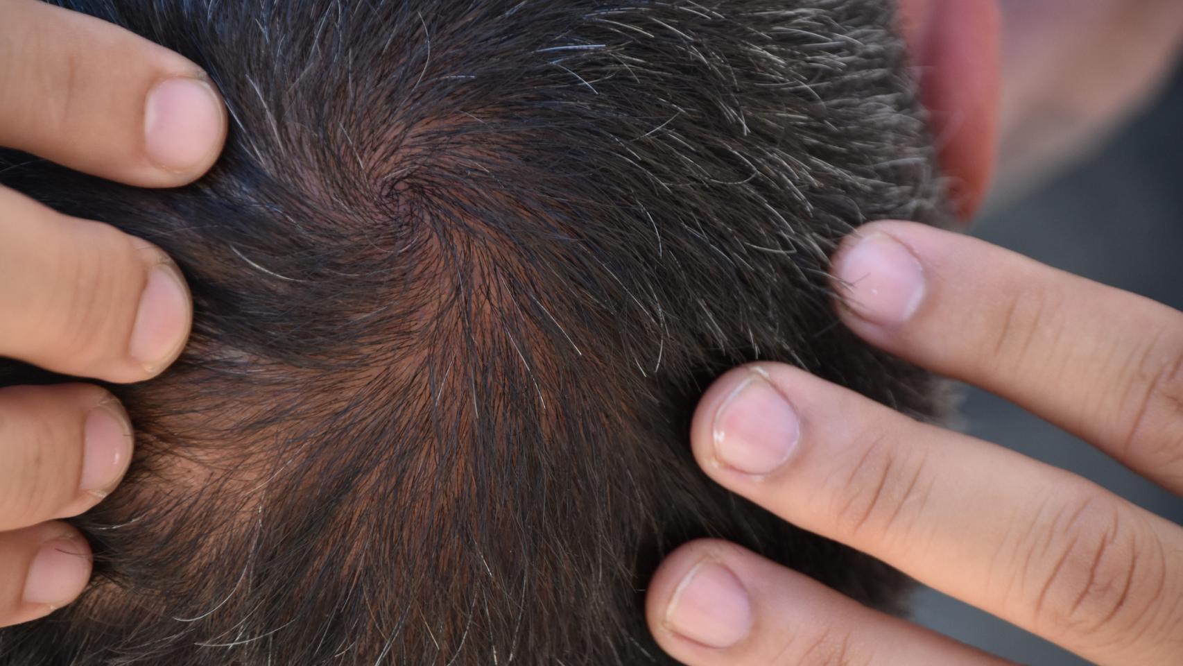 La nueva técnica japonesa que acaba con la calvicie y las canas: así ...