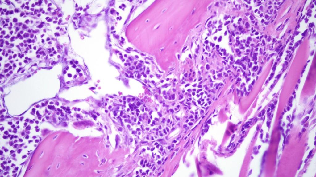 Golpe al mieloma: logran frenar el cáncer de sangre en pacientes que ...