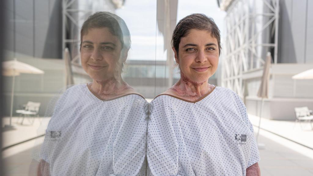 Ryma, quemada viva en Argelia, resucitó en Madrid: "Quise morir pero ...