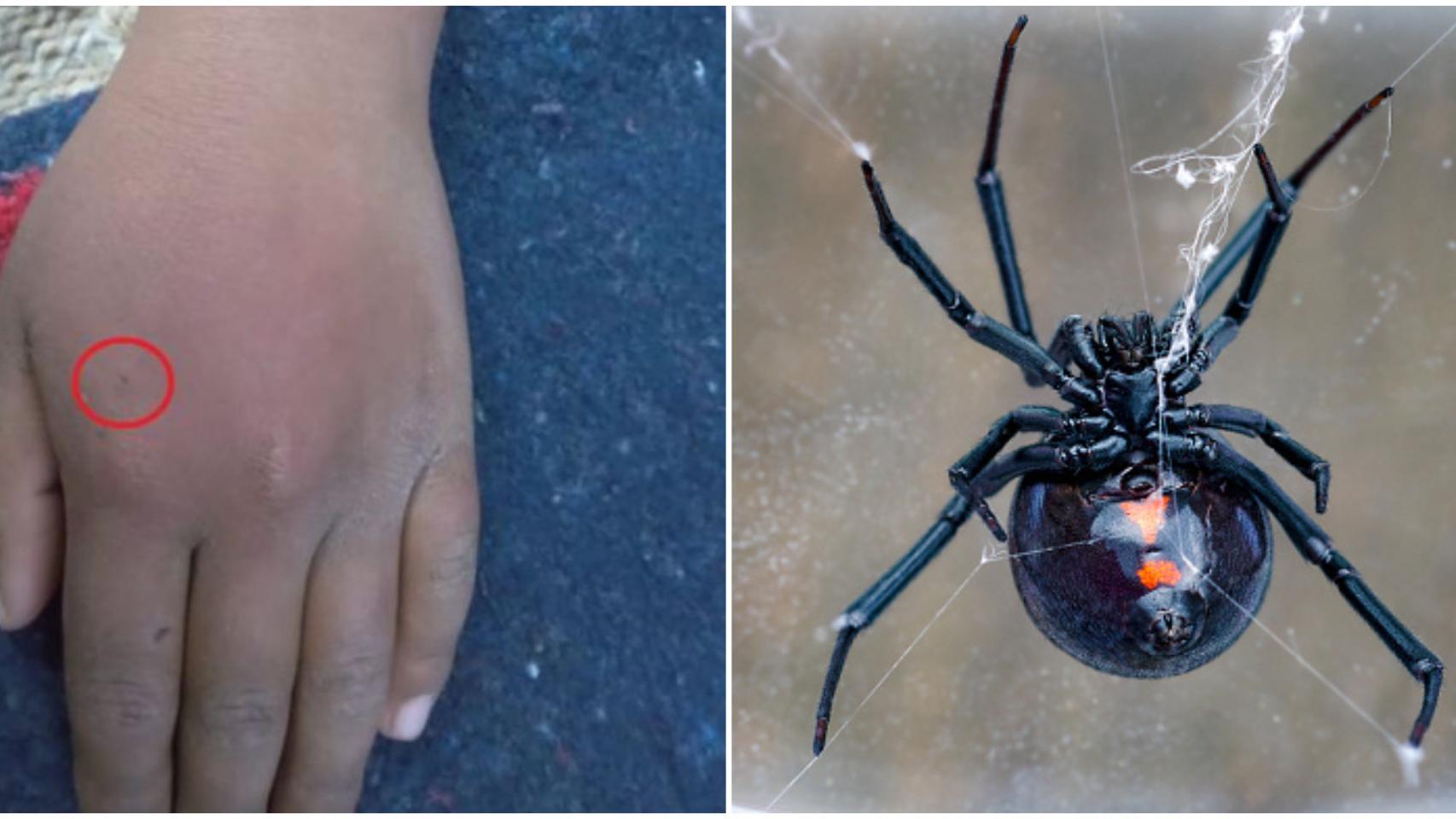 Mordedura De Viuda Negra