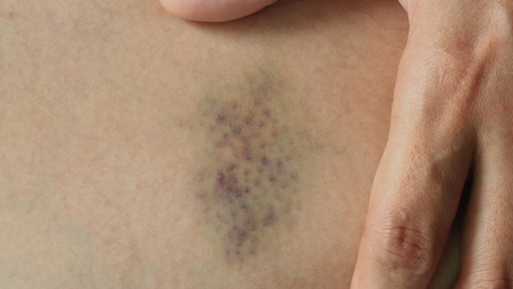 ¿Tienes hematomas? Este es el truco definitivo para quitarlos en 1 minuto (con algo que tienes ...